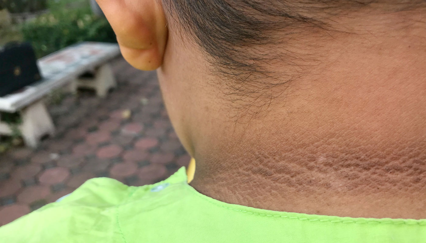 Acantose: O que é, Causas, Sintomas e Tratamentos - Cannalize