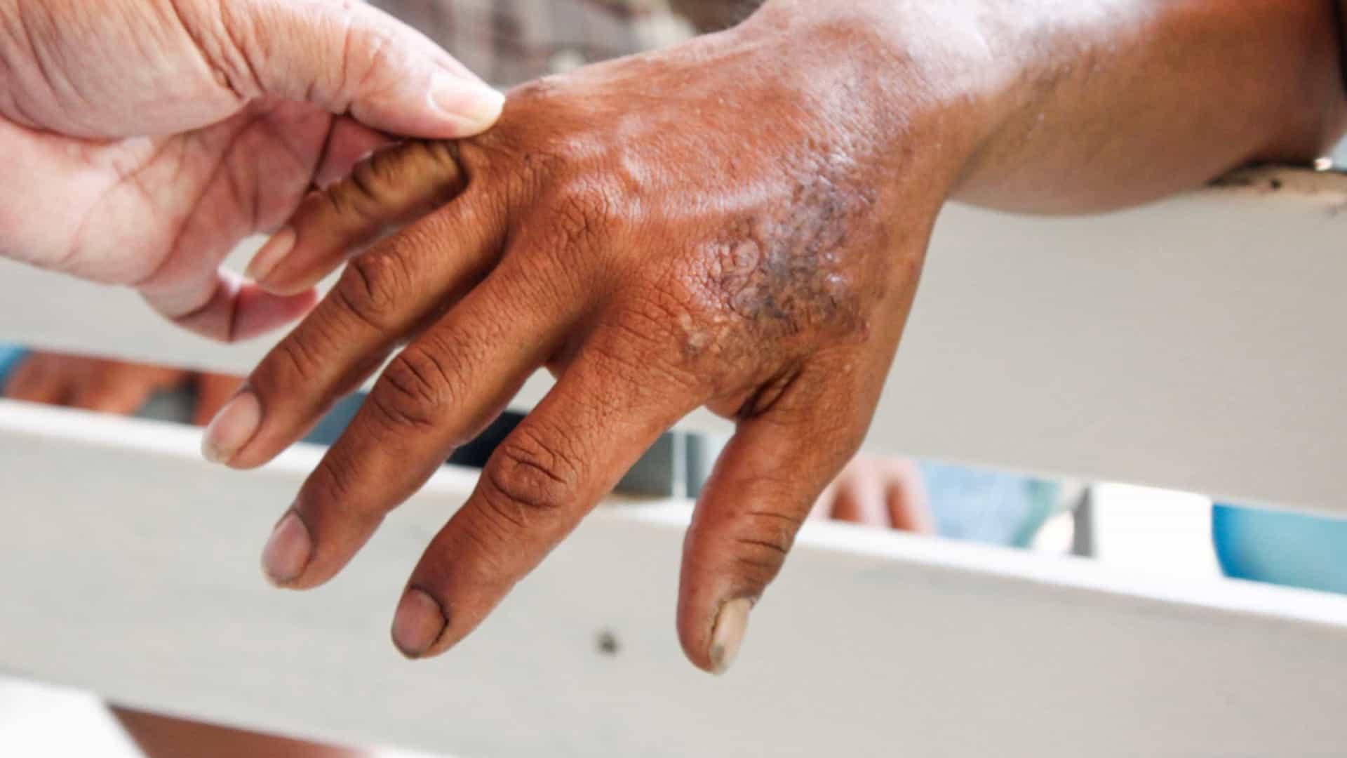 Hanseníase (Lepra): O que é, Causas, Sintomas e Tratamentos - Cannalize