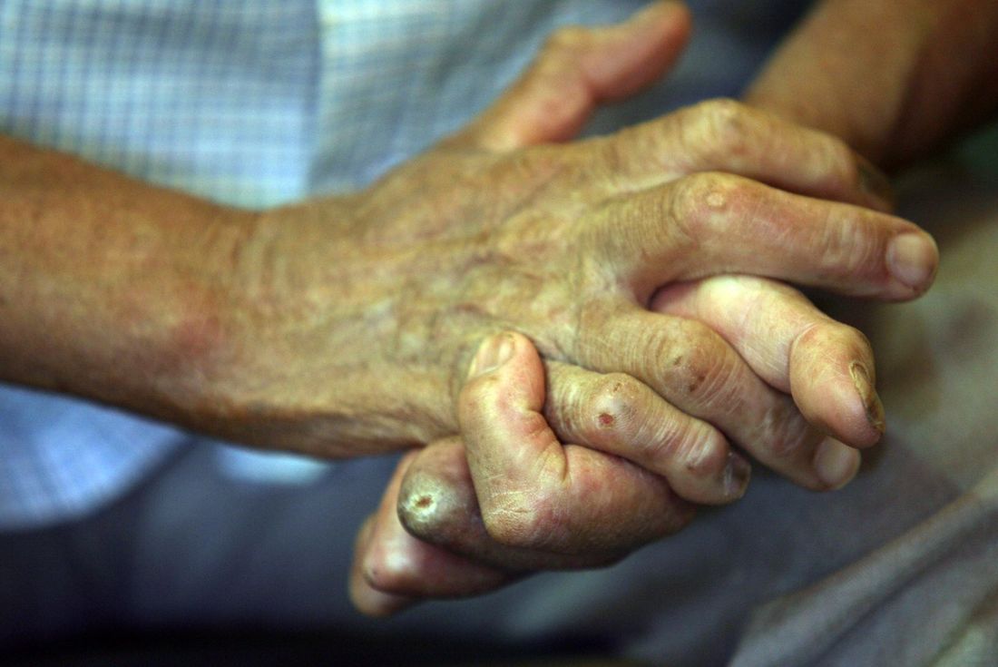 Hanseníase (Lepra): O que é, Causas, Sintomas e Tratamentos - Cannalize